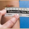 FREE Mantoux Tuberculin Skin Testing Ruler